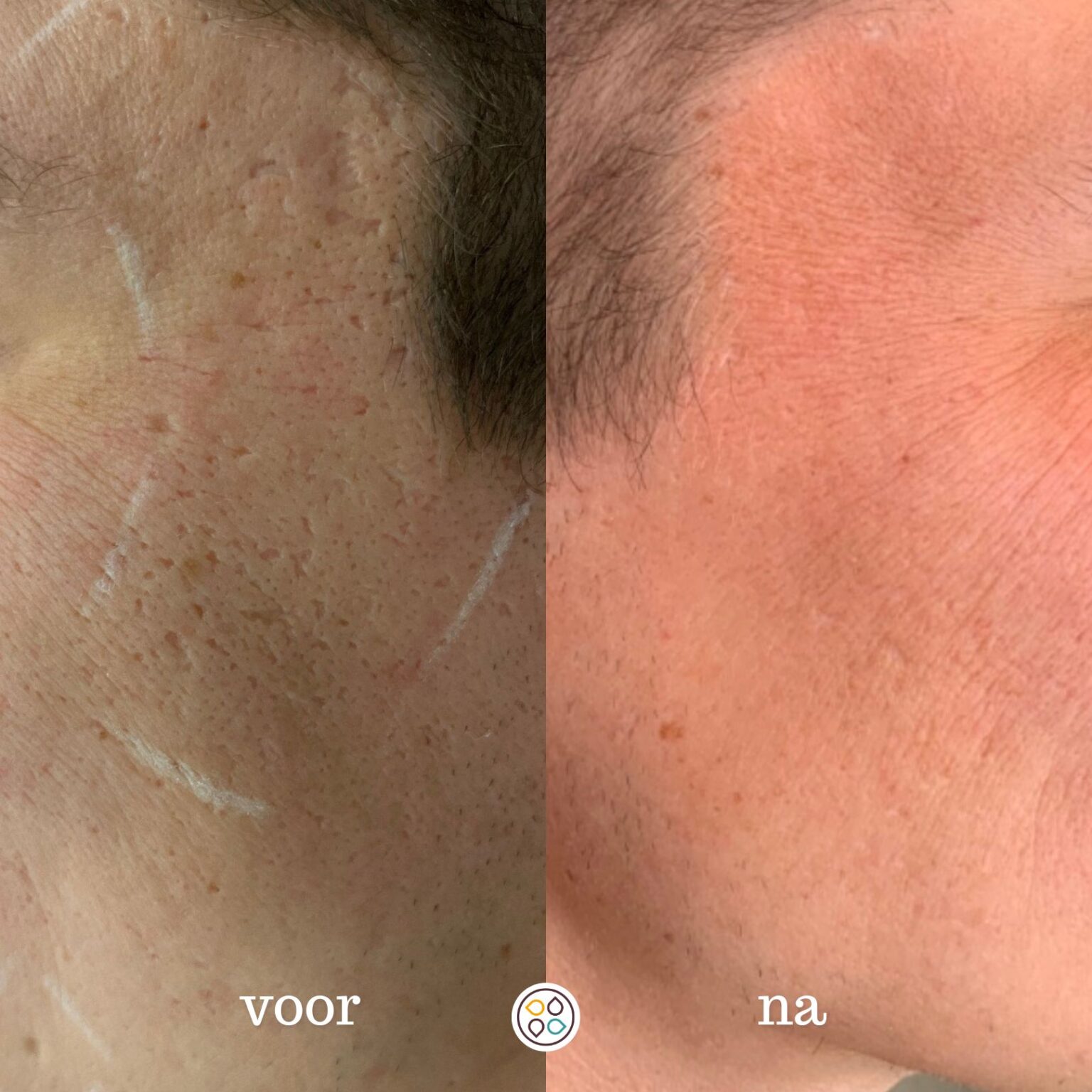 Littekens: alles over de soorten, oorzaken en behandelopties - Huidzorg West