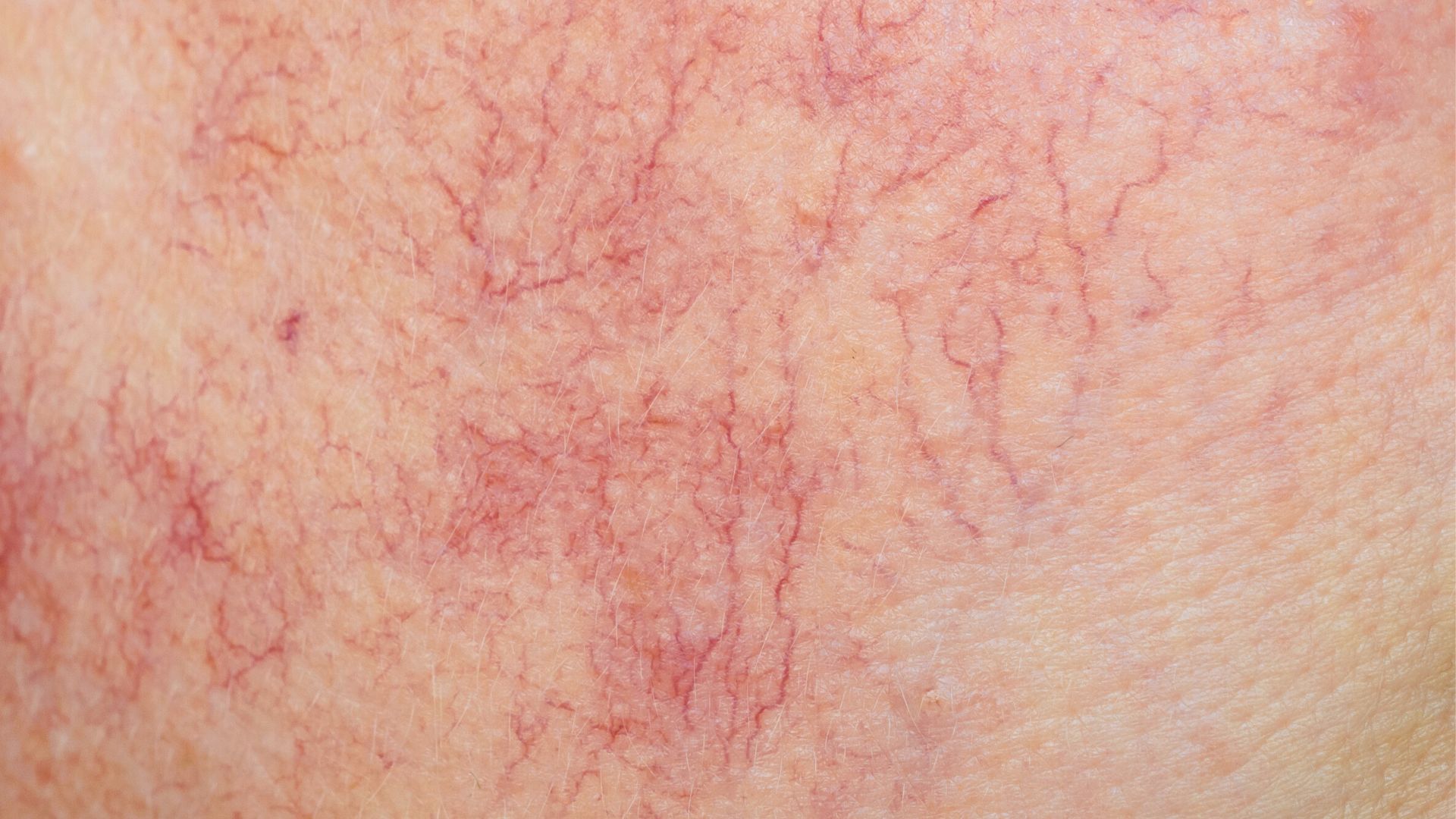 Couperose, wat kan ik daar tegen doen? - Huidzorg West