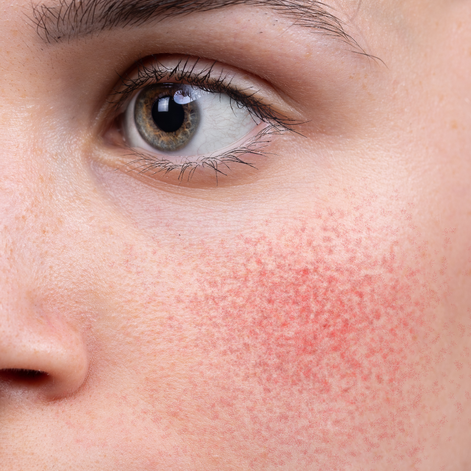 Huidprobleem - Diffuse roodheid - Huidzorg West