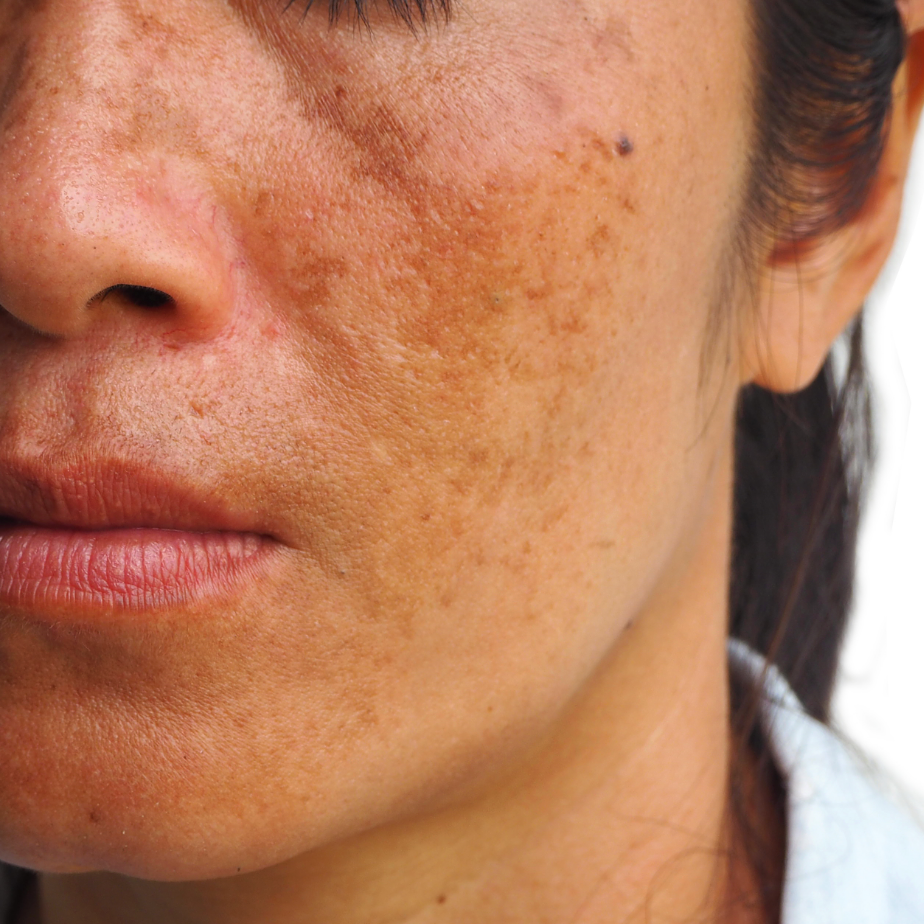 Skin problem - Melasma - Huidzorg West