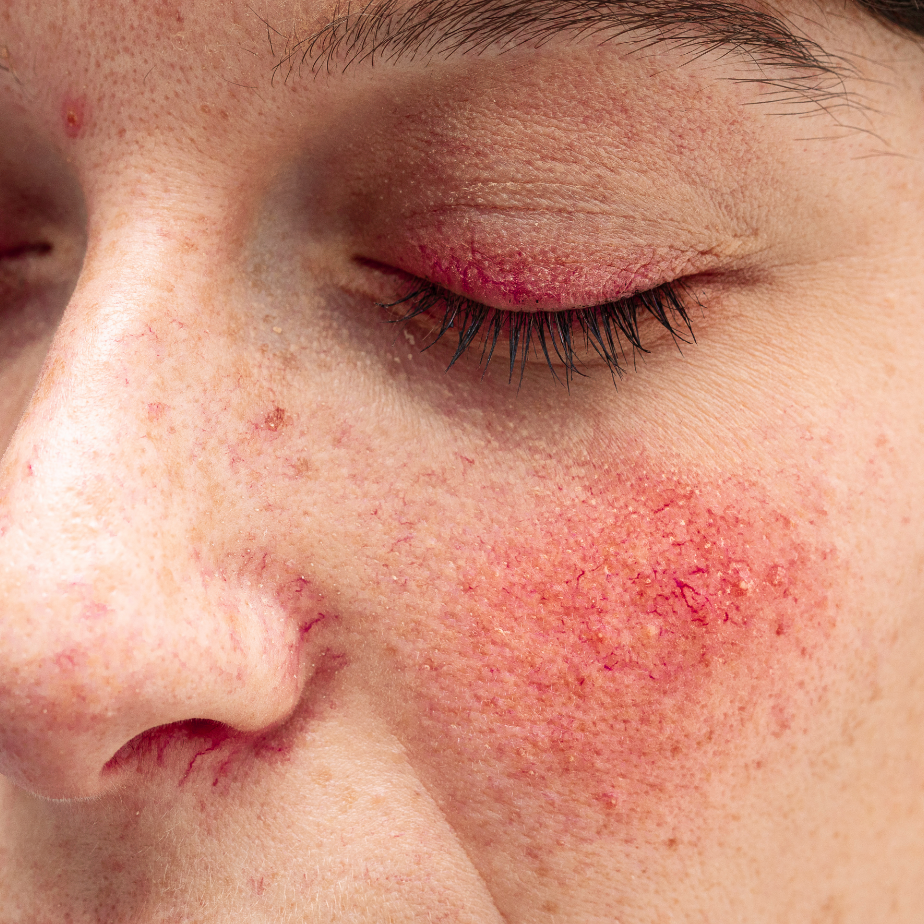 Skin problem - Rosacea - Huidzorg West