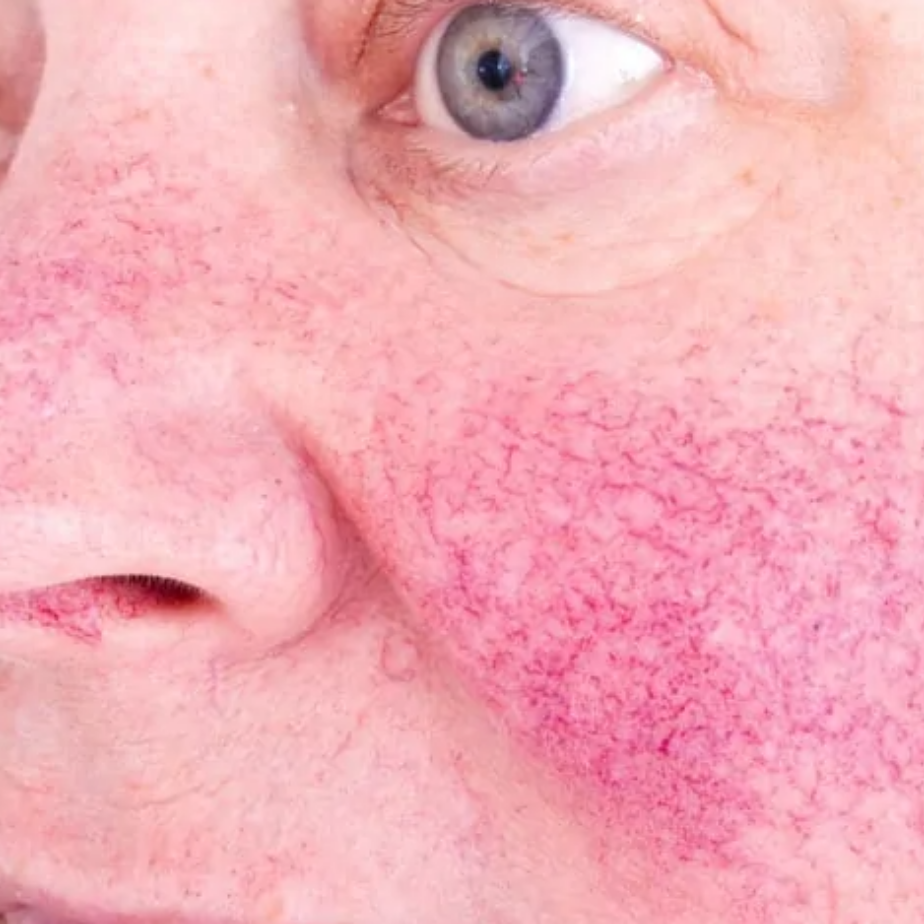 Huidprobleem - Couperose - Huidzorg West