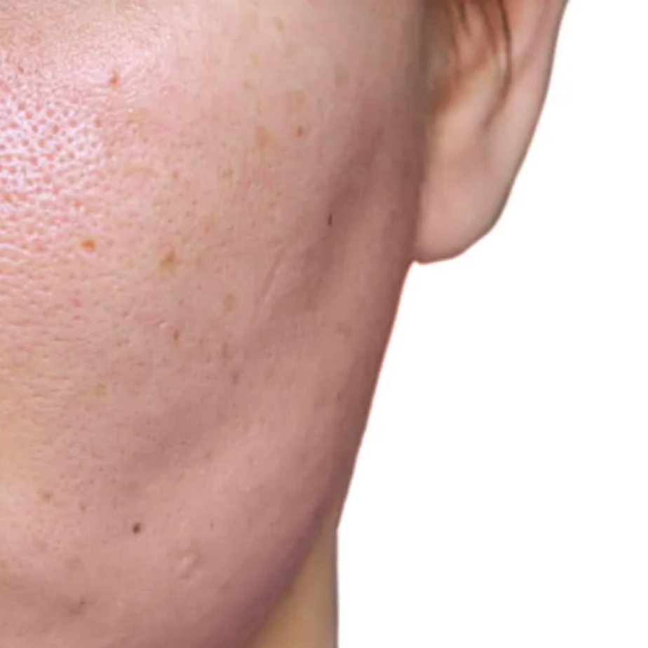 Skin problem - Dermatosis papulosa nigra - Huidzorg West