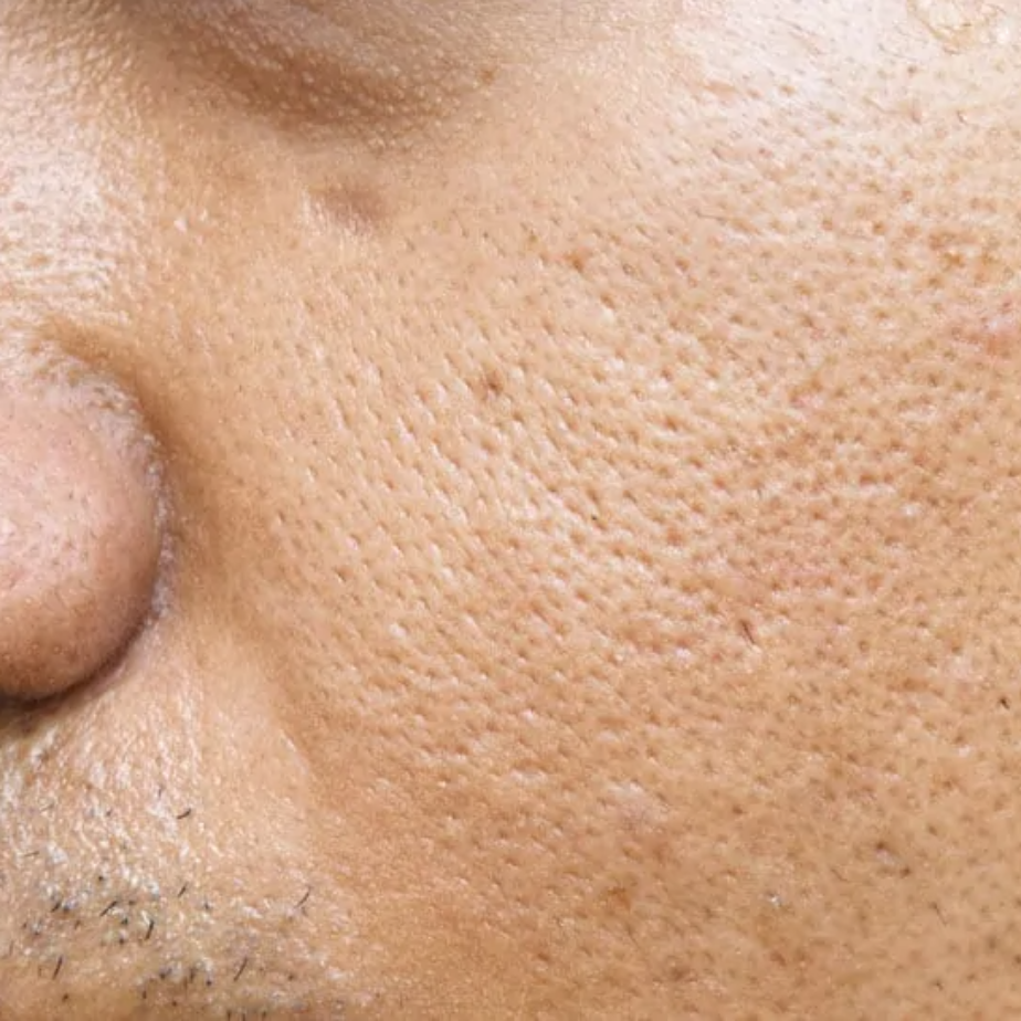 Huidprobleem - Grove Poriën - Huidzorg West