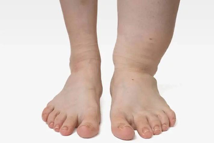 Huidprobleem - Oedeem - Huidzorg West