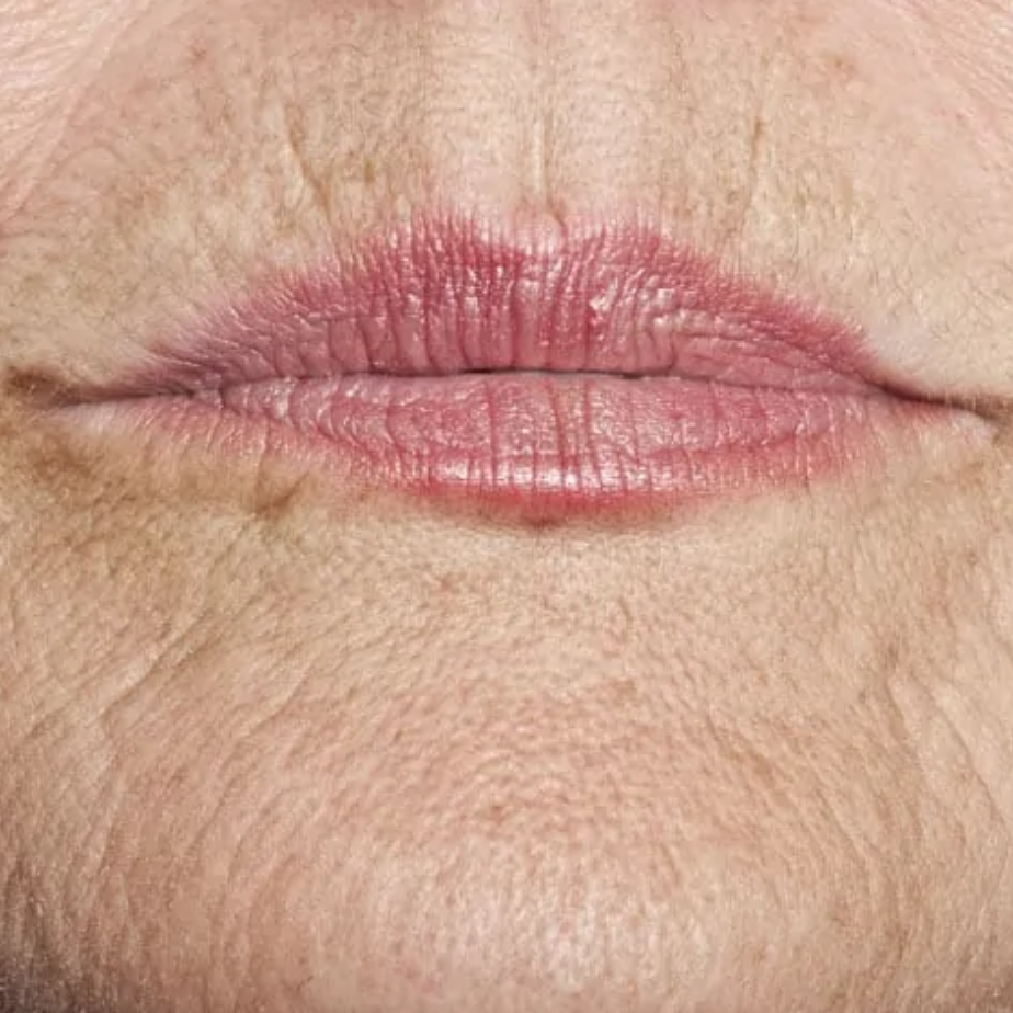 Skin problem - Ageing Skin - Huidzorg West