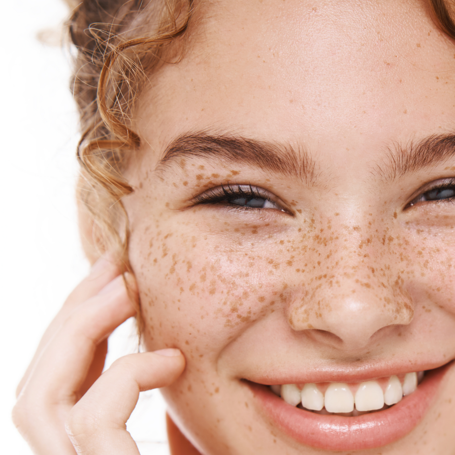 Huidprobleem - Sproeten - Huidzorg West