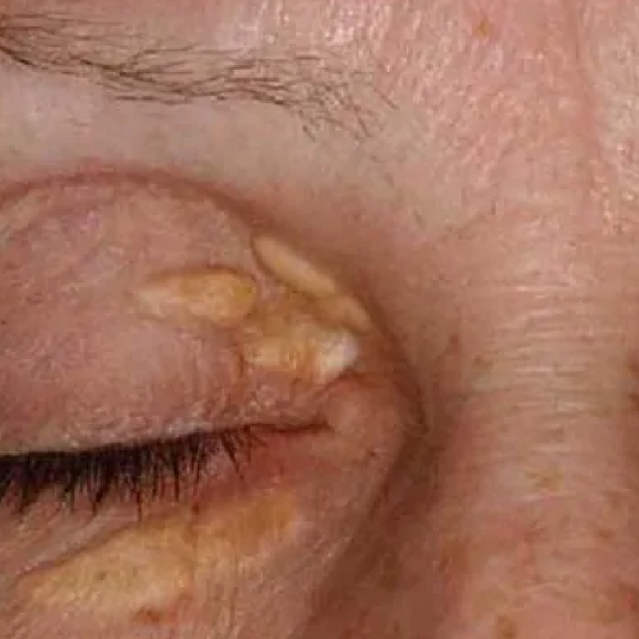Xantelasma Xanthelasma Removal London Dermasurge Clinic